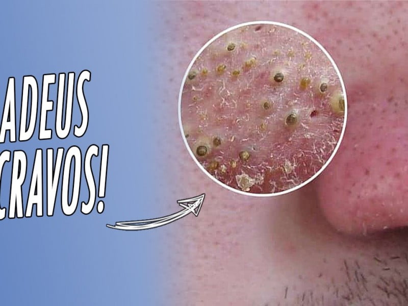 COMO EVITAR E REMOVER CRAVOS NO ROSTO! - Homens que se Cuidam