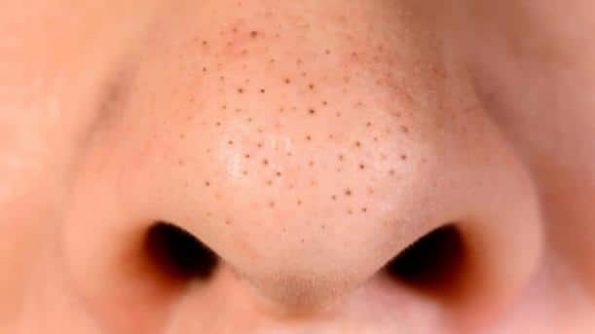 Cravo no rosto, Como Prevenir e Tratar? | Homens que se Cuidam